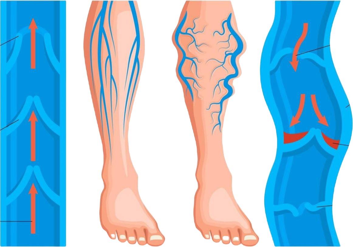 Varicose Vein Treatment in Hyderabad - Go Vascular